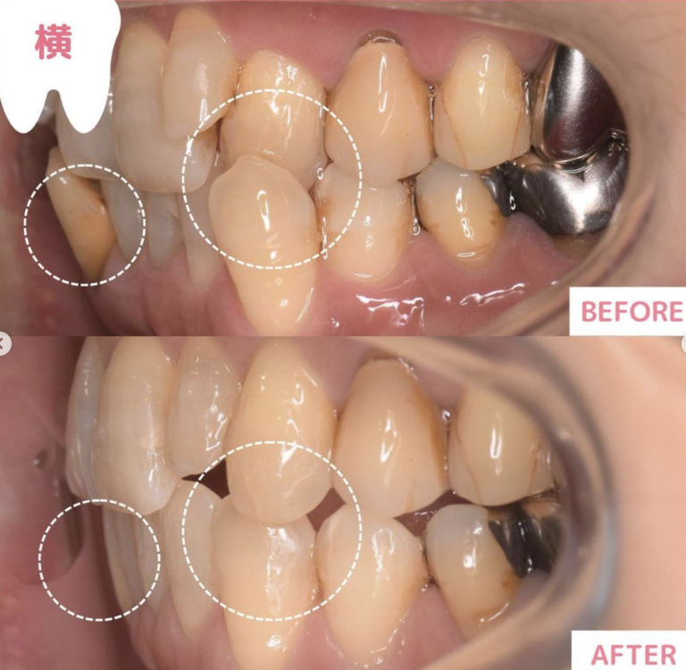 インビザラインの効果はいつから実感できるの？マウスピース矯正の効果を解説｜インビザキレイラインカレッジ