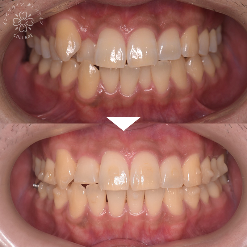 症例｜インビザキレイラインカレッジ