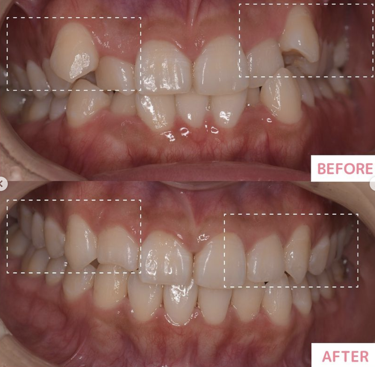 インビザラインの経過で効果を実感するまでの期間を症例写真とともに解説｜インビザキレイラインカレッジ