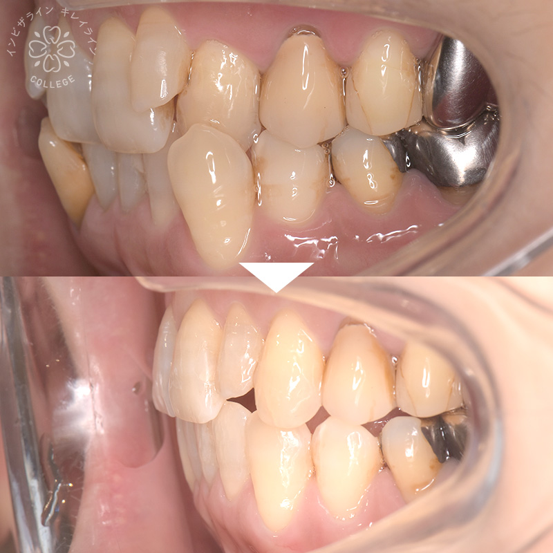 症例｜インビザキレイラインカレッジ