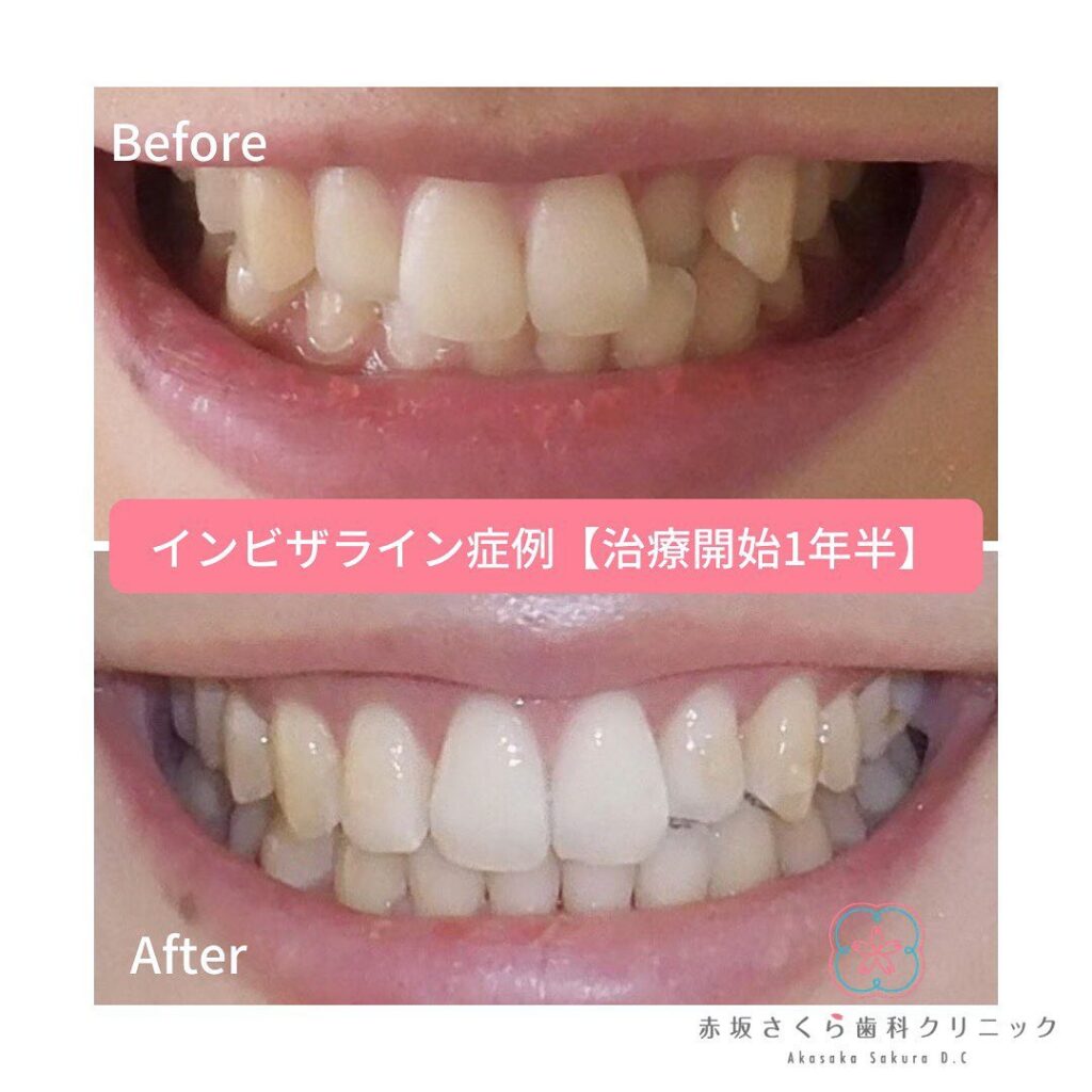 歯並び矯正とは？矯正が必要な歯並びは？おすすめの矯正方法も紹介！｜インビザキレイラインカレッジ