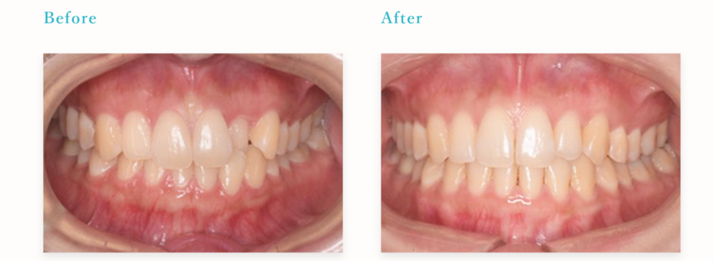 インビザラインの効果はいつから分かる？おすすめ歯科も紹介！｜インビザキレイラインカレッジ